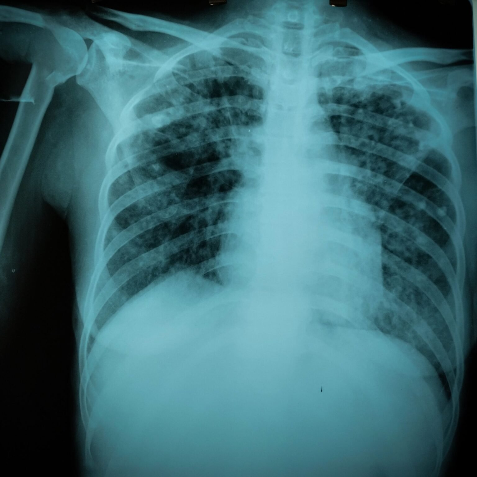 Tuberculosis: The World's Leading Infectious Killer and How to Protect ...